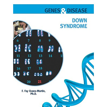【】Down Syndrome