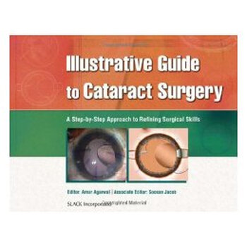 【】ILLUSTRATIVE GUIDE CATARACT
