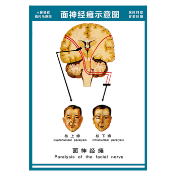 医院科室宣教挂图人体结构示意图器官解剖图全身骨骼图宣传画墙贴画覆膜防水贴纸WSA51 WSA51-07 面神经瘫示意图 60*40厘米 覆膜防水PP贴纸