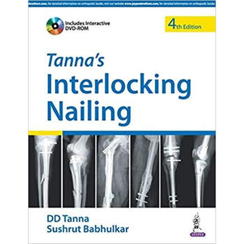 Tanna's Interlocking Nailing