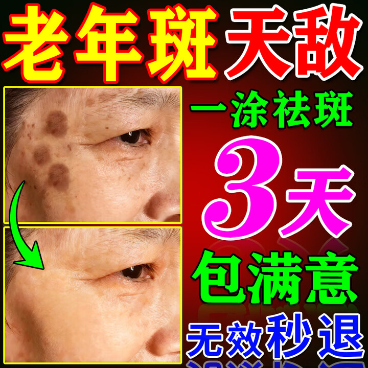 百易方祛斑霜老年斑专用的(非药)一夜消强力祛除脸部手部背男女士老人斑 买5赠4【重度老年斑】九盒装(发货特效快) 医用美白祛斑霜正品淡化黑色素 ...
